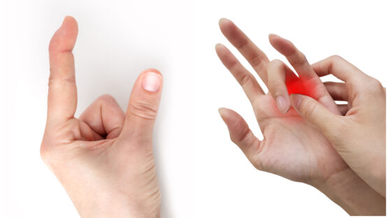 Sticky fingers: what to do about trigger finger and mallet finger - The ...