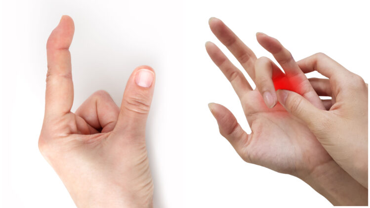 Sticky fingers: what to do about trigger finger and mallet finger - The ...